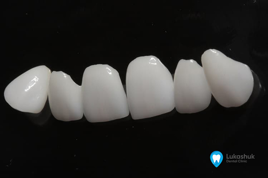 Вініри Київ | Ціна Установки на Один Зуб - Клініка Лукашука
